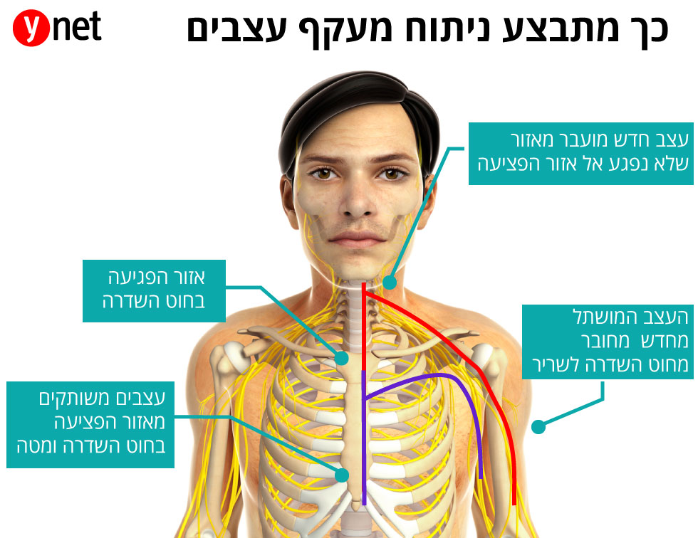 פריצת דרך: משותקים החלו להניע את היד בעקבות ניתוח מעקף עצבים